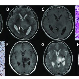 Cases Of Diffuse Midline Gliomas A E A Case Of Diffuse Midline Download Scientific