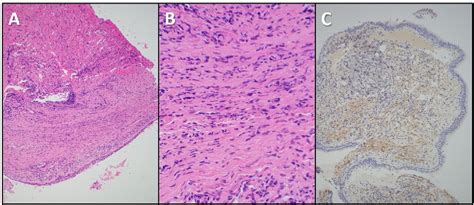 Figure 1 From Pulmonary Inflammatory Pseudotumor Causing Lung Collapse