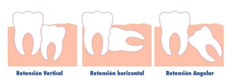 Qué son las muelas del juicio y qué hacer cuando salen Clínica Dental