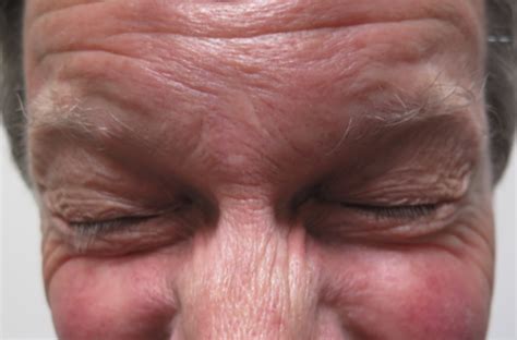 Blepharospasm Botox Before And After