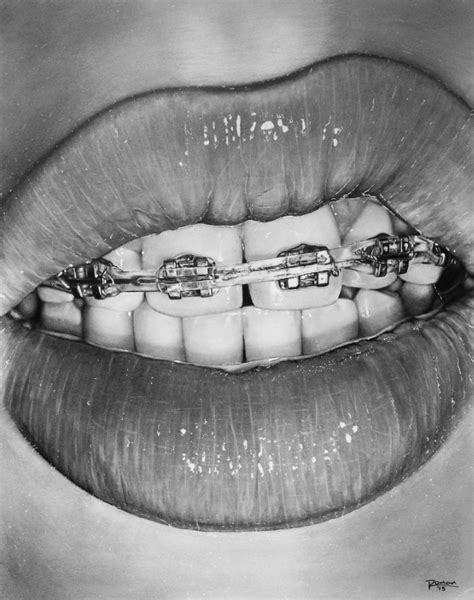 Braces Drawing At Landon Artis Blog