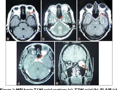 Figure 1 From Orbital Tuberculosis With Coexisting Fungal Aspergillus