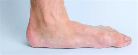 Tibialis Posterior Tendon Dysfunction Pttd Sydney Physio Clinic