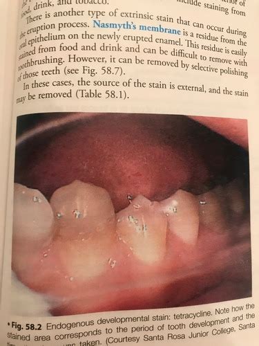 Endogenous Staining Of Teeth