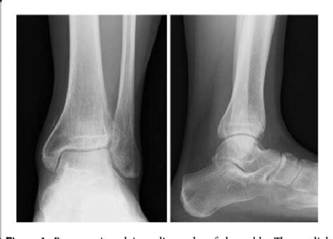 Tillaux Fracture Semantic Scholar