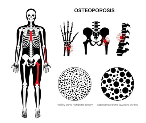 Premium Vector Osteoporosis Disease Poster Systemic Skeletal Disorder