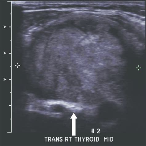 Thyroid Scintigraphy Showing A Dominant Hot Nodule On The Inferior Download Scientific
