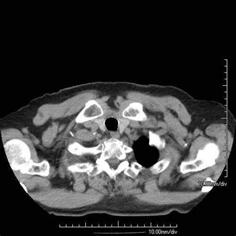 大動脈解離（aortic Dissection）