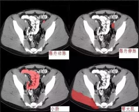 十分钟带你学习腹部 CT 解剖 医学界 助力医生临床决策和职业成长