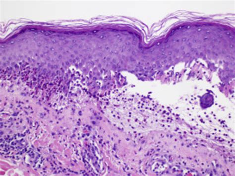 Biopsy Section Of A Bullous Lesion On The Left Upper Thigh Shows A