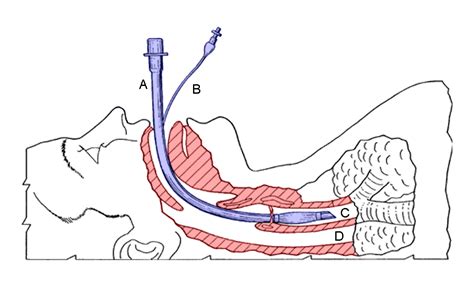 Intubation