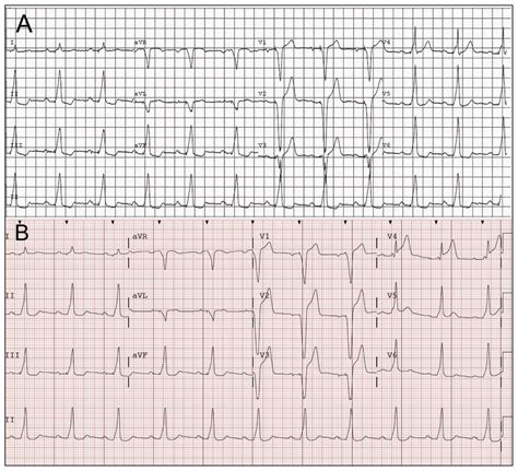 Sgarbossa Criteria For Acute Myocardial Infarction Cmaj