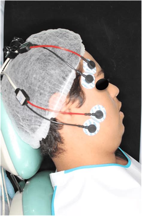 Electromyography Electrode Implantation At Neida Tracy Blog