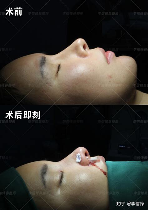 网红鼻的最终归宿就是修复吗从网红鼻到妈生鼻的改变之路 深圳李信锋隆鼻综合整形案例分享 知乎