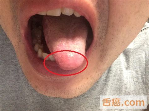 舌癌初期の画像（写真）をシェアします（口内炎との比較） 舌癌と初期で宣告された男のブログ（闘病記）