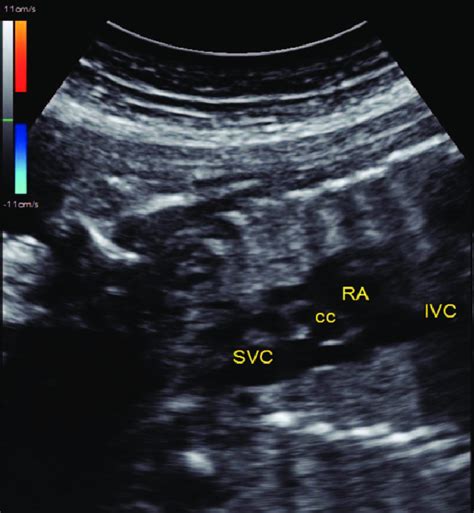 Prenatal Echocardiography Oblique Bicav View Dilated Svc Due To The Download Scientific