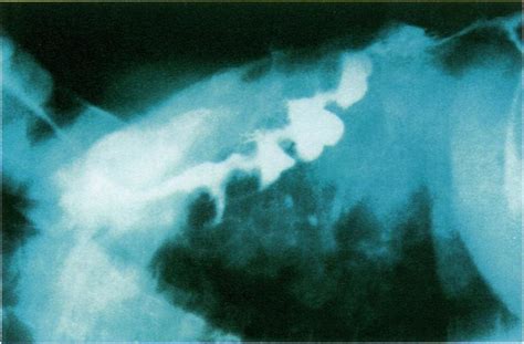 Radiographic Results After Barium Swallow Showing The Substernal Colon