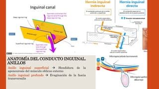 Hernia Inguinal Pptx