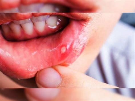 Mouth Ulcer Home Remedies What To Do In Mouth Ulcers Mouth Ulcer Home