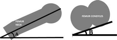 Definition Of Femoral Anteversion Angle Measurement On Axial Ct A Is