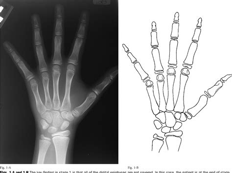 Sanders Classification Bone Age My Xxx Hot Girl
