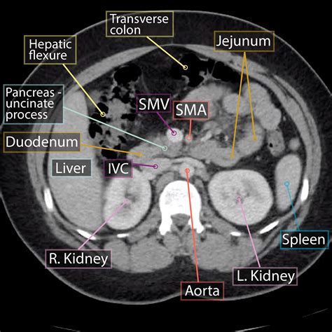 Gross Anatomy Glossary Axial Abdominal Ct Ditki Medical And Biological