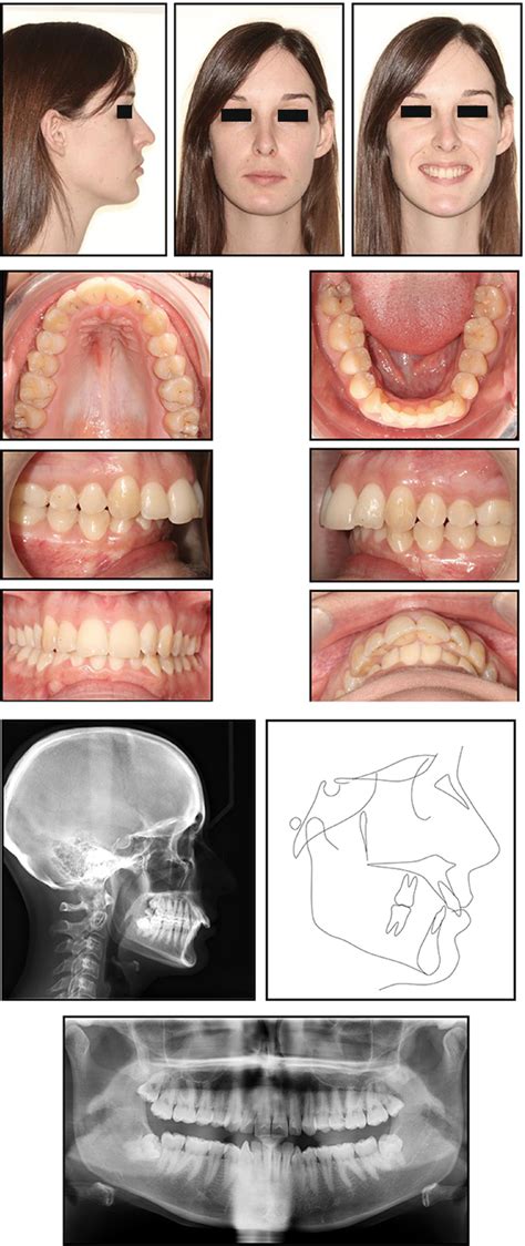 Pre‐treatment Records Extraoral Photos Intraoral Photos Panoramic Download Scientific