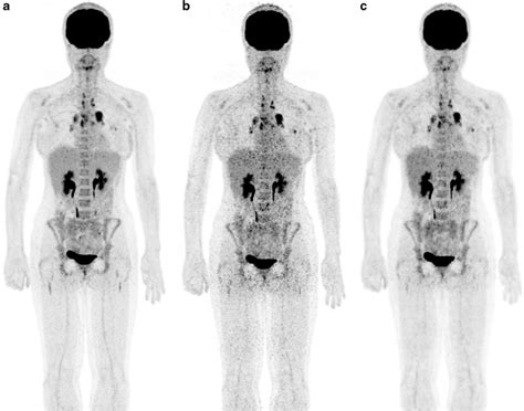 ¹⁸f Fdg Pet Scan Of A 29 Year Old Woman With Hodgkin Lymphoma And