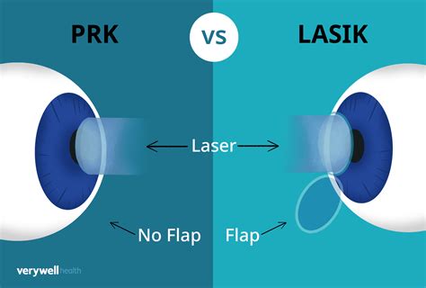 Prk Vs Lasik Which Laser Eye Surgery Is Best