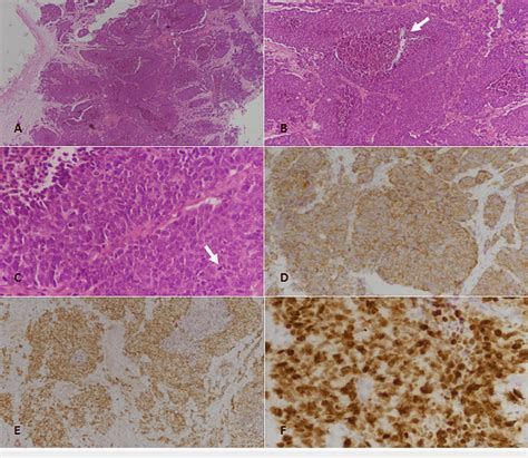 Poorly Differentiated Neuroendocrine Carcinoma Of Primary Lung Origin