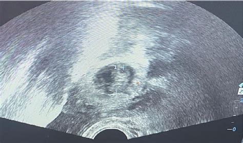 Figure 1 From Spontaneous Heterotopic Pregnancy Diagnosis And Surgical