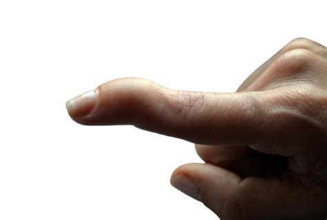 Mallet Finger Diagnosis And Treatment Ladan Hajipour Manchester