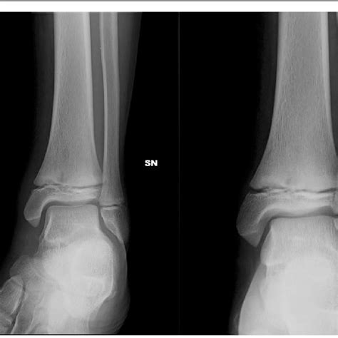 Pdf Bilateral Tibial Brodies Abscess In A Young Patient Treated With