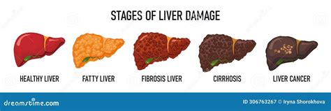 Stages Of Liver Destruction Stock Vector Illustration Of Chronic