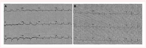 Figure 1 From Simultaneous St Elevation Myocardial Infarction In
