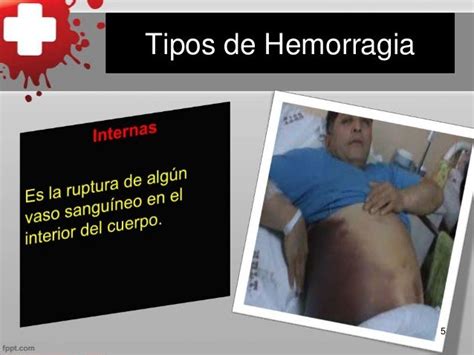 Tratamento De Hemorragia Interna