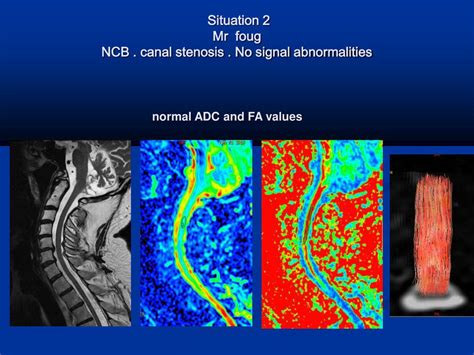 Ppt Diffusion Tensor Tractography Of The Spinal Cord Powerpoint Presentation Id 3556618