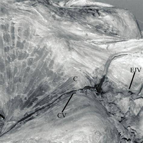 Right Deltopectoral Groove And Neck Cv Cephalic Vein C Clavicle