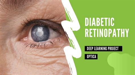Diabetic Retinopathy Deep Learning Project Lets Diagnosis This