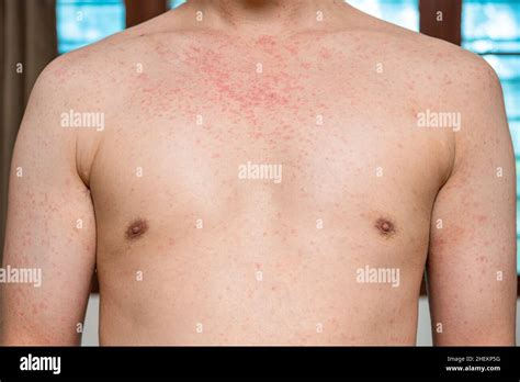 Dermatitis Rash Viral Disease With Immunodeficiency On Body Of Young