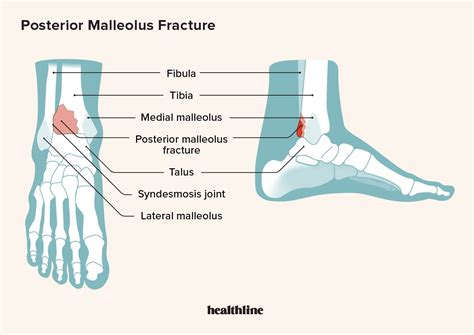 Medial Malleolus
