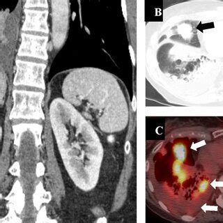 TP53 Mutation In Endometrial Adenocarcinoma With Omental Metastasis