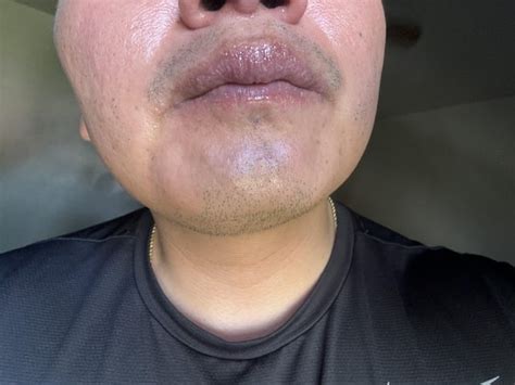 Small White Itchy Bumps On Lips Nostrils Rdermatologyquestions