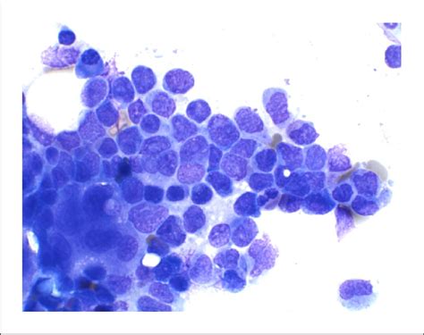 Bone Marrow Aspirate Of Acute Myeloid Leukemia With Monocytic