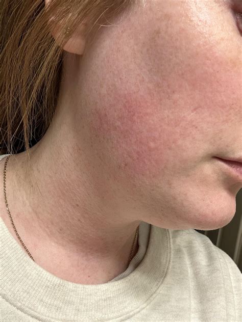 Kprf — Keratosis Pilaris Rubra Faciei R 30plusskincare