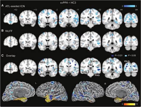 Semantic Variant Ppa Svppa Shows Distributed Reductions In Intrinsic