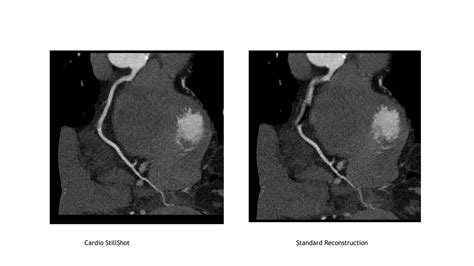 Capture 6x Better Temporal Resolution Cardiac Imaging At Any Heart Rate