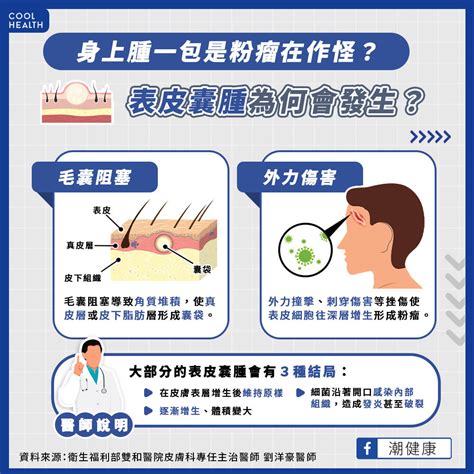 皮膚突然「腫一大包」是粉瘤發作？ 醫教2方法徹底根除