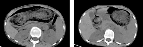 Ct Scan Of Abdomen Revealed A Heterogeneous Mass In The Stomach Cavity