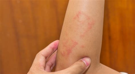 Dermatitis Kontak Gejala Penyebab Dan Pengobatan Halodoc
